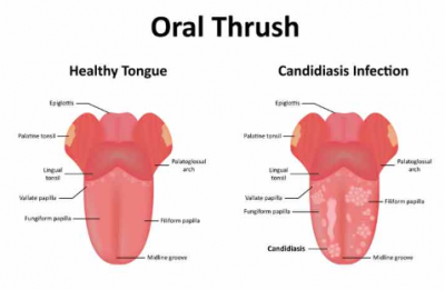 Yeast infection in Mouth: Oral Thrush, Causes, Remedies - Healtreatcure